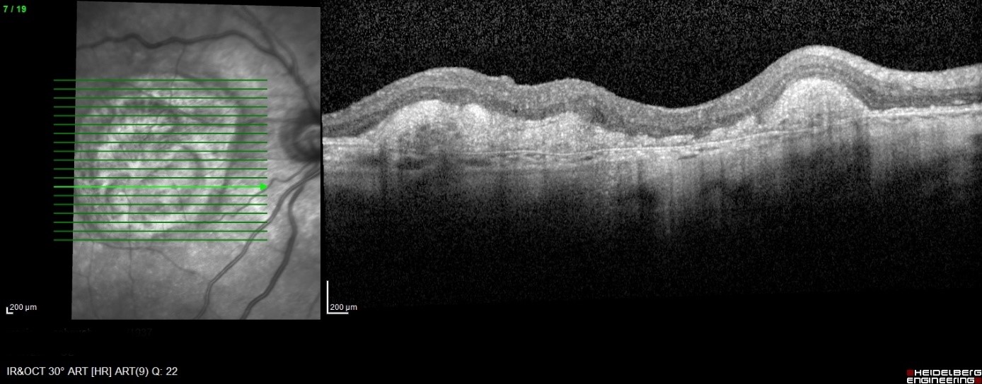 DMLA : les différentes formes, diagnostic et traitements
